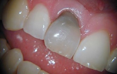 How Long Can a Tooth Infection Go Untreated - [Symptoms and Causes]