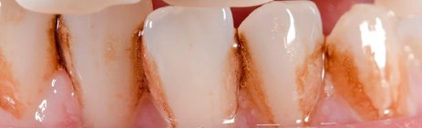 Why Is Dry Mouth Risky For Your Teeth - [ Xerostomia ]