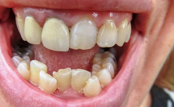 I Have Really Bad Teeth - What Are My Options?