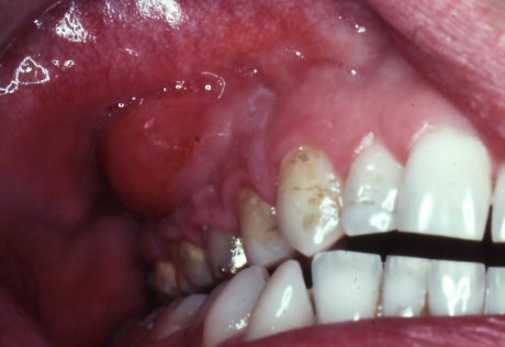 Tooth Abscess Nightmare - [Untreated Dental Infection]