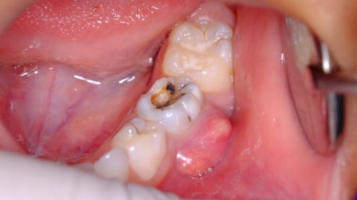 How Long Until a Tooth Infection Kills You - Know About Your Teeth