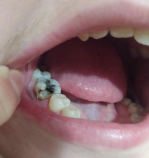 Identified Bacteria and Its Surprising Link to Tooth Decay