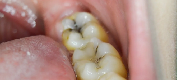 Causes and Solutions For Recurrent Cavities in Adults