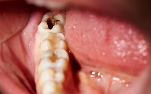 Identified Bacteria and Its Surprising Link to Tooth Decay