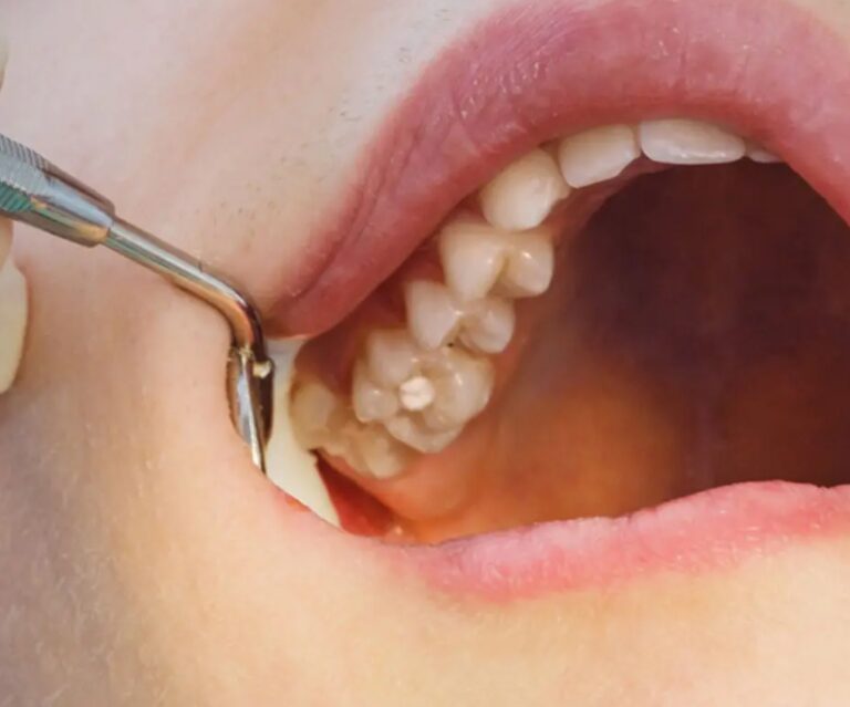 Lost a Dental Filling? Here’s a Comprehensive Guide
