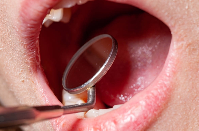 Lost a Dental Filling? Here’s a Comprehensive Guide